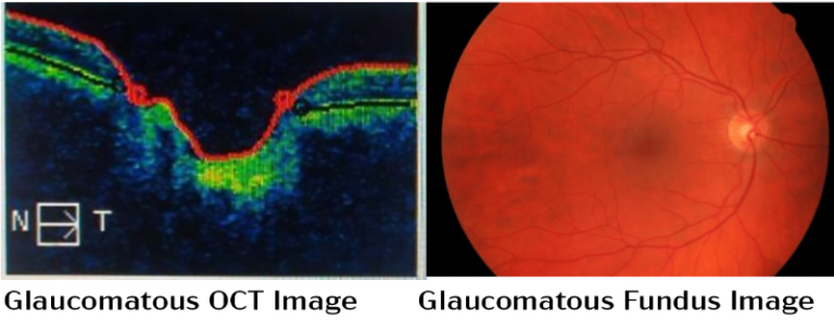 As an eye doctor, if you had glaucoma, how would you like to be treated ...